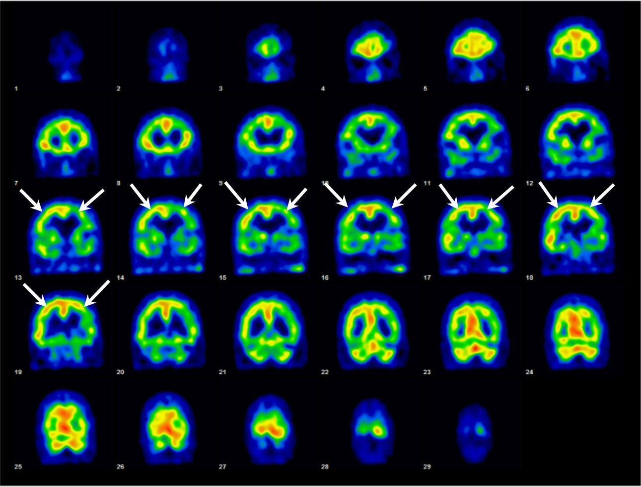 特発性正常圧水頭症（iNPH：idiopathic normal pressure hydrocephalus）: みんなのための認知症、ED ...